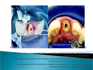 Basic principles of endodontics | PPT