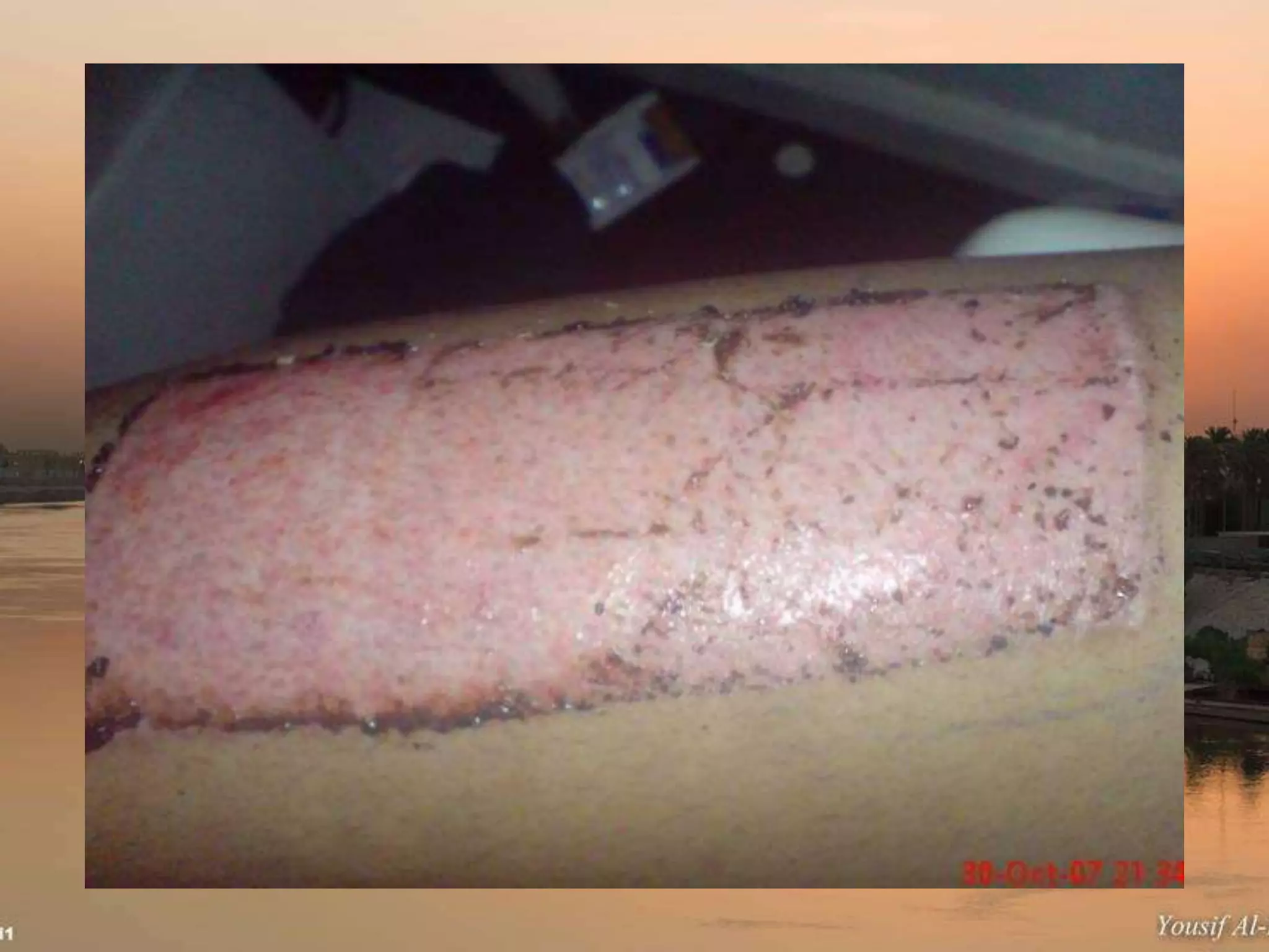 Basic principles of flaps | PPSX