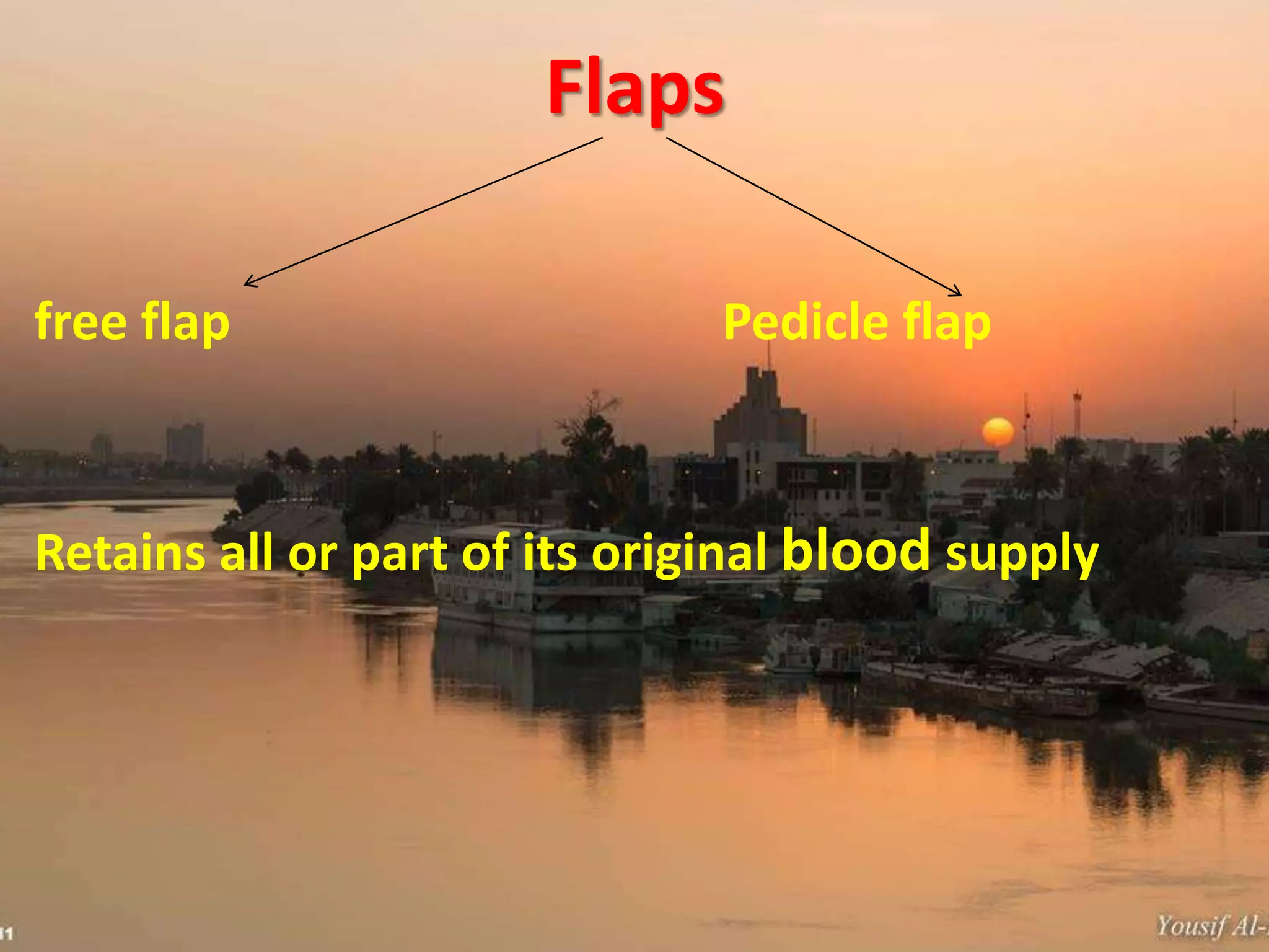 Basic principles of flaps | PPSX