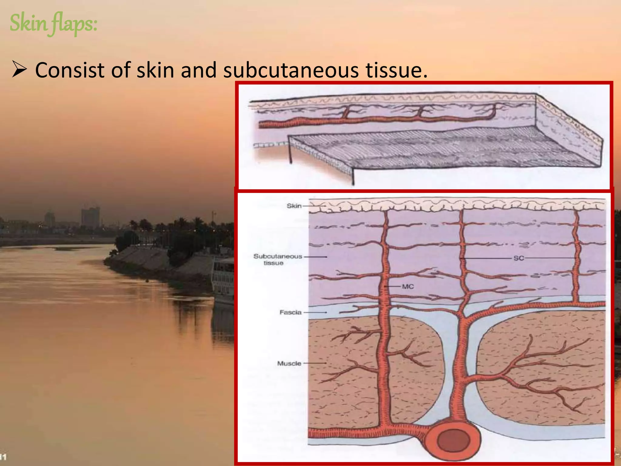 Basic principles of flaps | PPSX