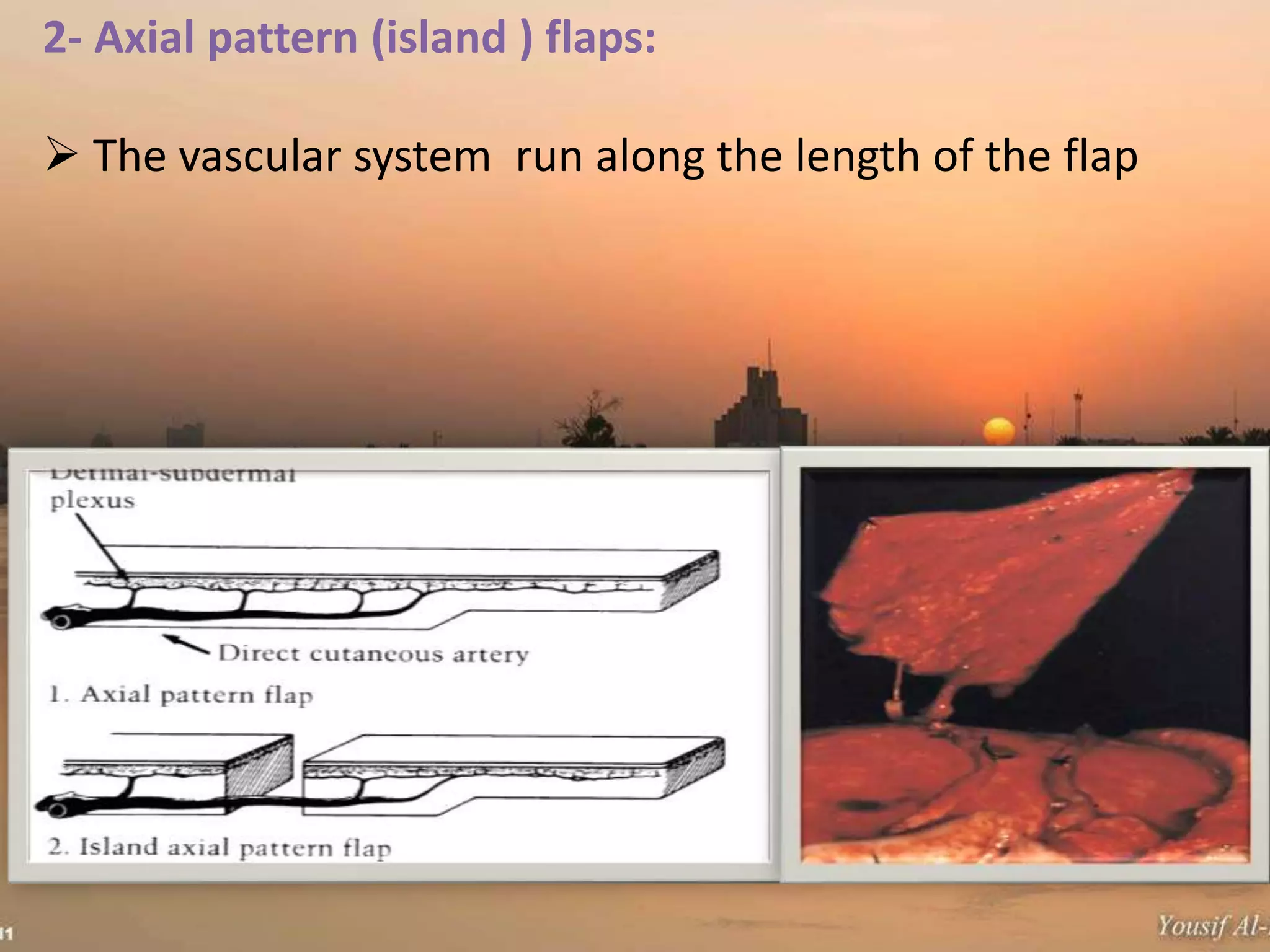 Basic principles of flaps | PPSX