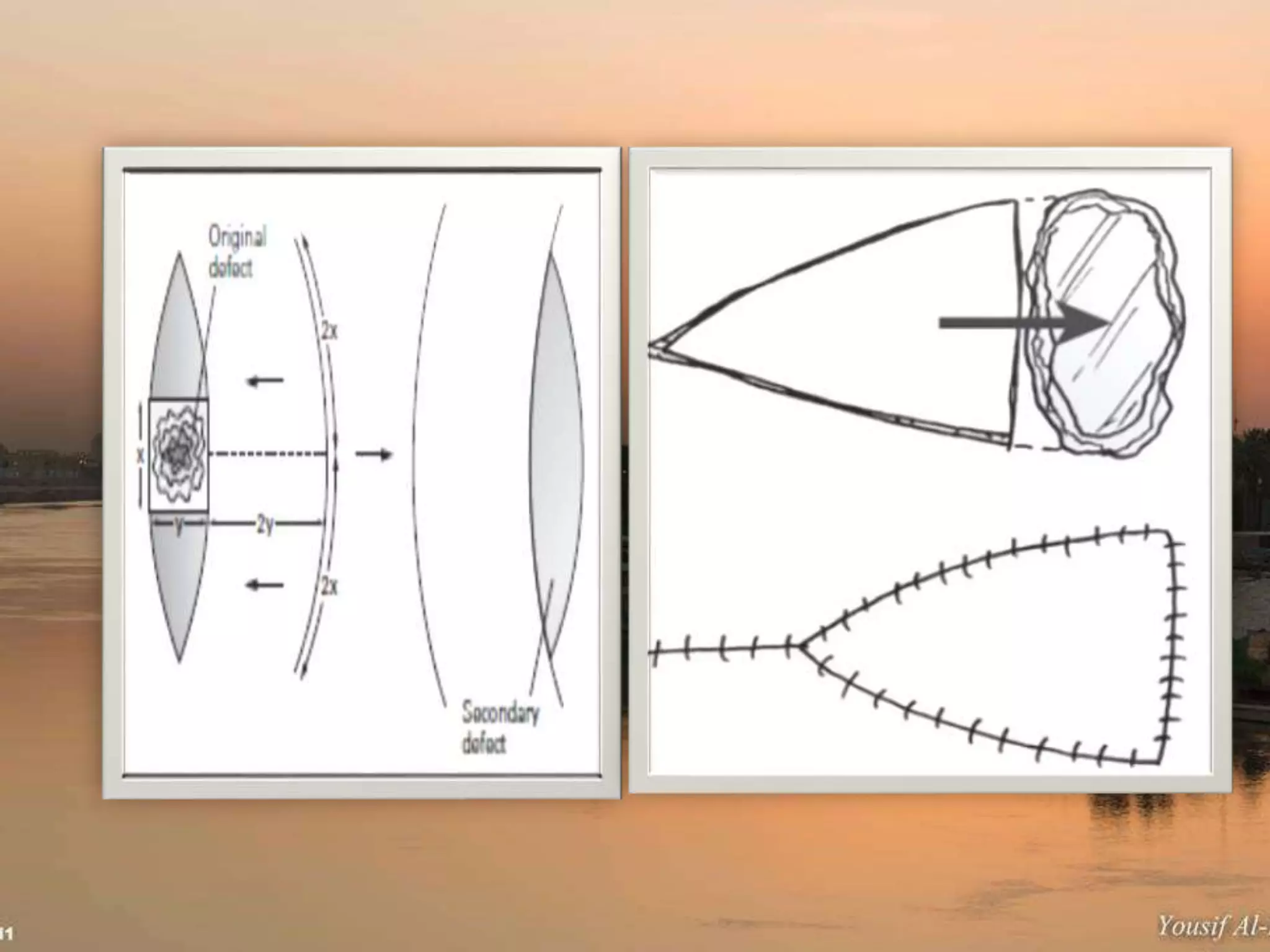Basic principles of flaps | PPSX