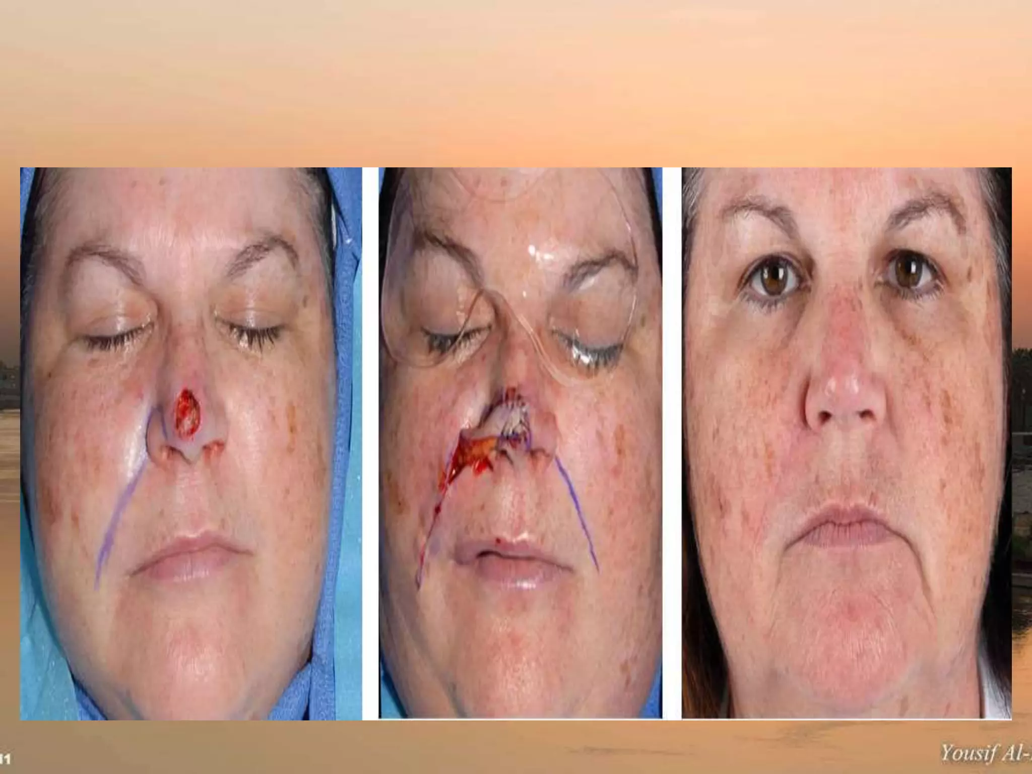 Basic principles of flaps | PPSX