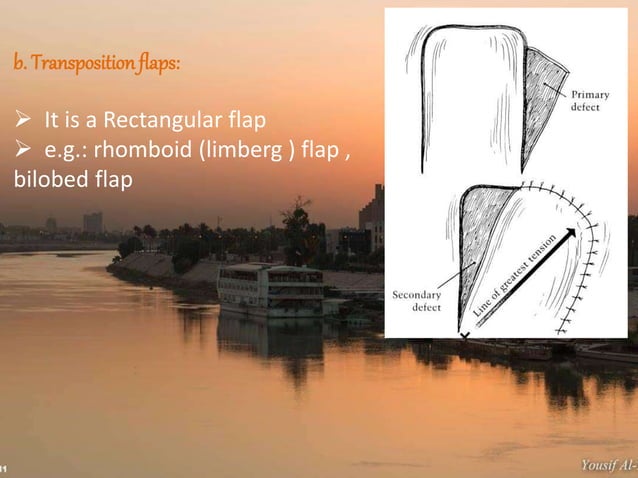 Basic principles of flaps | PPSX | Skin and Dermatology | Diseases and ...