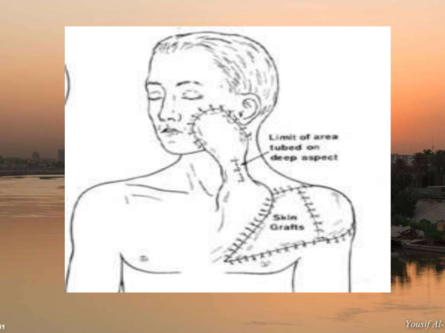Basic principles of flaps | PPSX | Skin and Dermatology | Diseases and ...