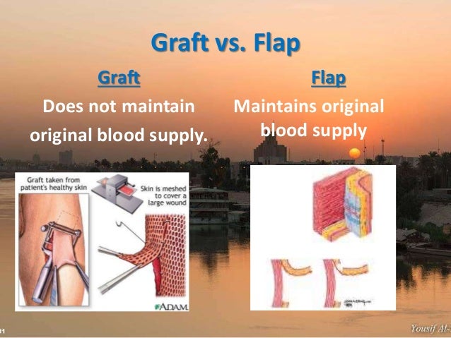 Basic principles of flaps