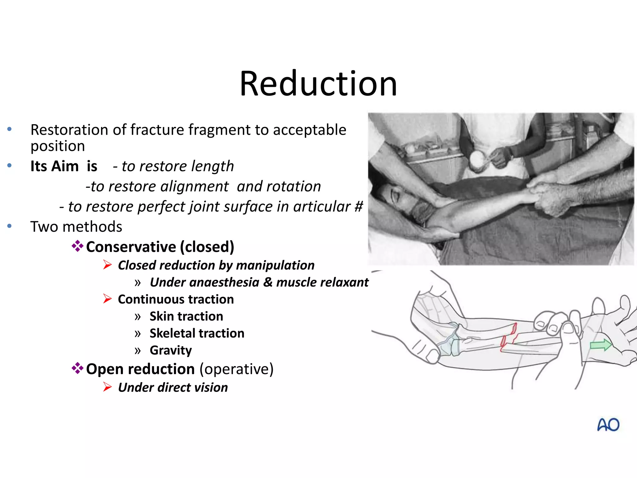 Basic principles of fracture management.pptx