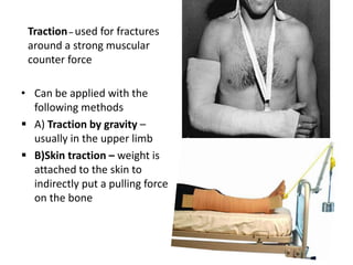Basic principles of fracture management.pptx