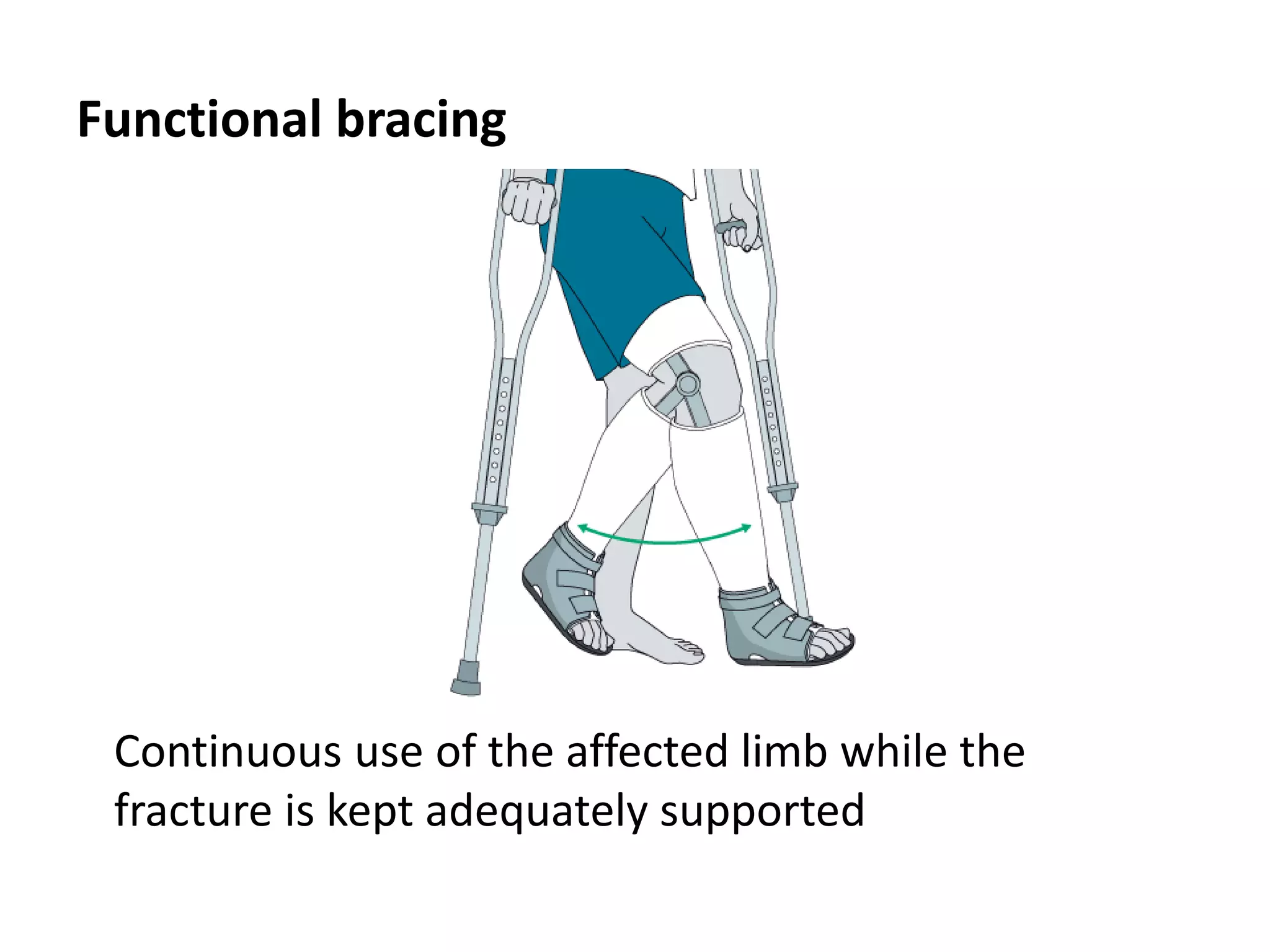 Basic Principles of Fracture Management | PDF