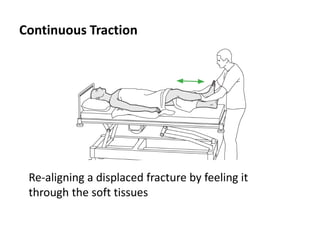 Basic Principles of Fracture Management | PDF