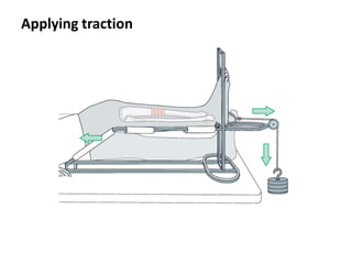 Basic Principles of Fracture Management | PDF