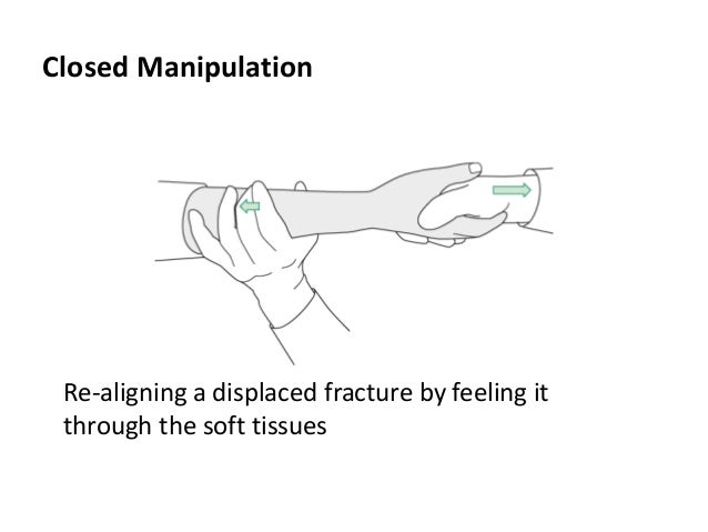 Basic Principles of Fracture Management