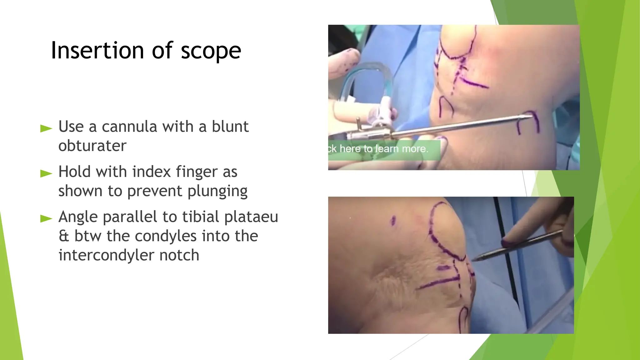 Basic principles of knee arthroscopy Part 2.pptx