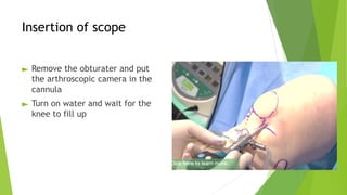 Basic principles of knee arthroscopy Part 2.pptx