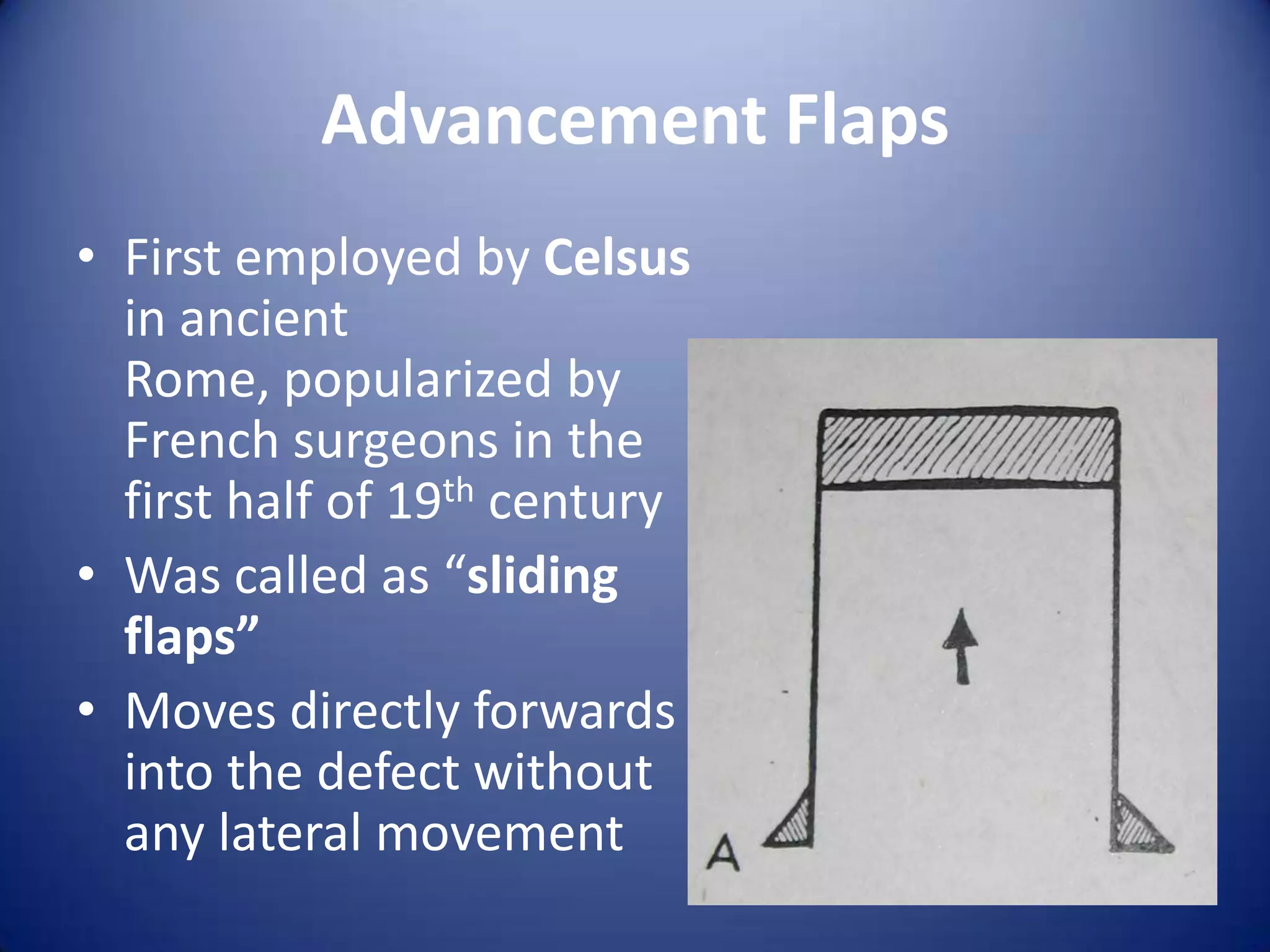 Basic Principles Of Local Flap In Plastic Surgery | PPTX
