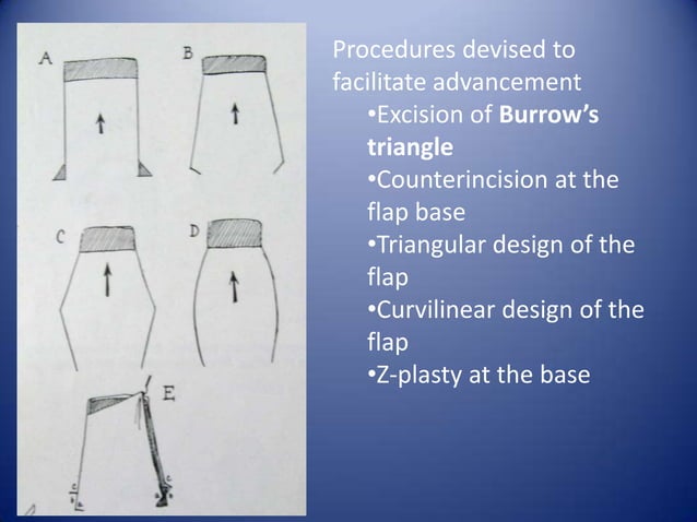 Basic Principles Of Local Flap In Plastic Surgery | PPTX | Surgery ...