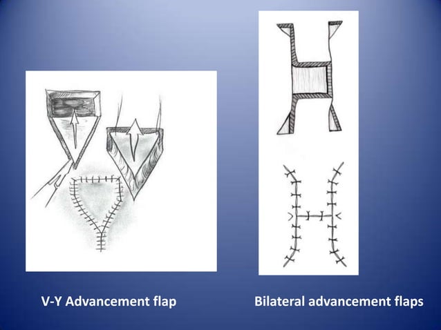 Basic Principles Of Local Flap In Plastic Surgery | PPTX | Surgery ...