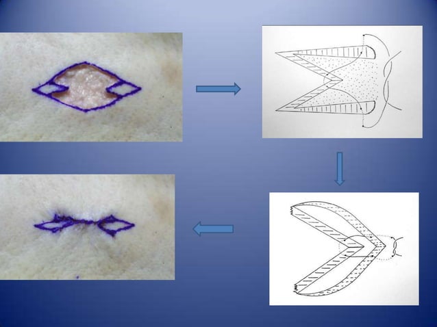 Basic Principles Of Local Flap In Plastic Surgery | PPTX | Surgery ...