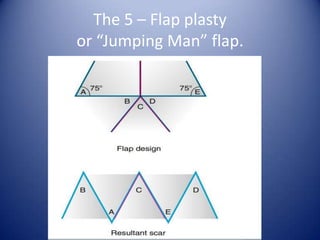 Basic Principles Of Local Flap In Plastic Surgery | PPTX