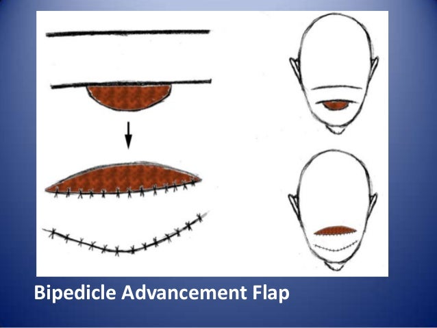 Basic Principles Of Local Flap In Plastic Surgery
