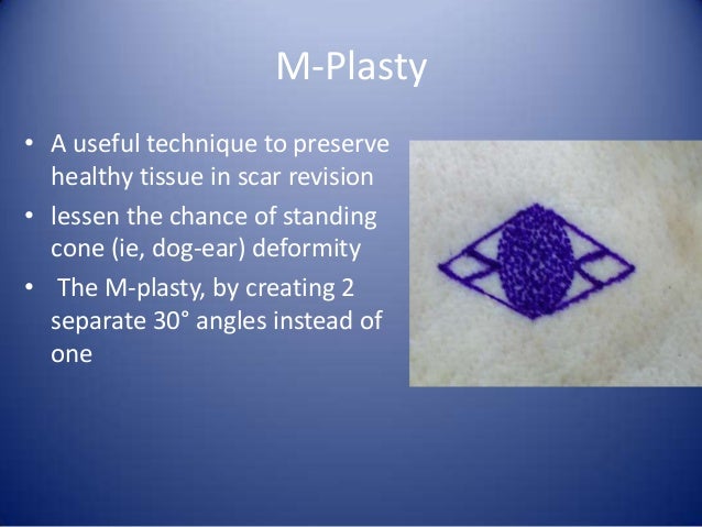 Basic Principles Of Local Flap In Plastic Surgery