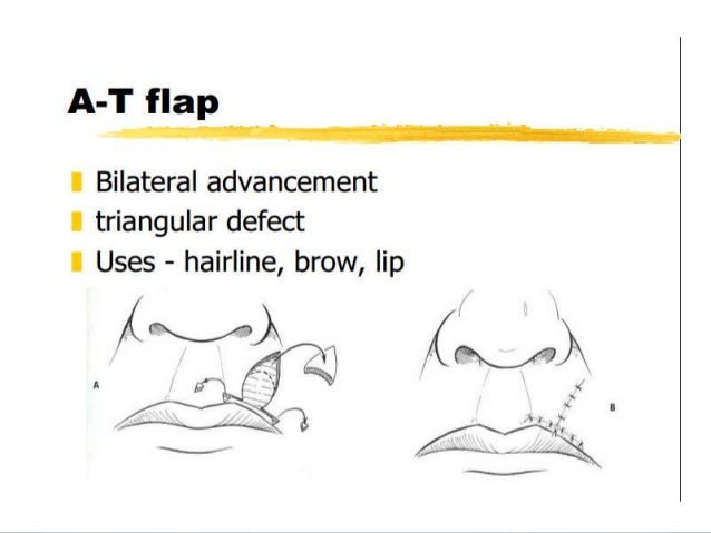 Basic Principles Of Local Flap In Plastic Surgery