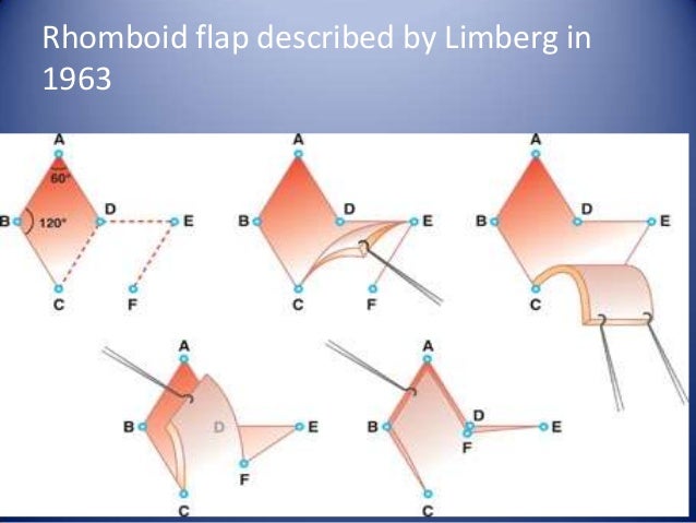 Basic Principles Of Local Flap In Plastic Surgery