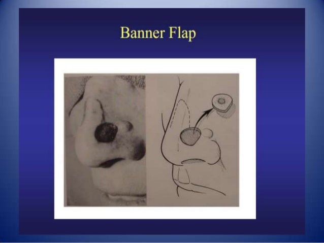 Basic Principles Of Local Flap In Plastic Surgery