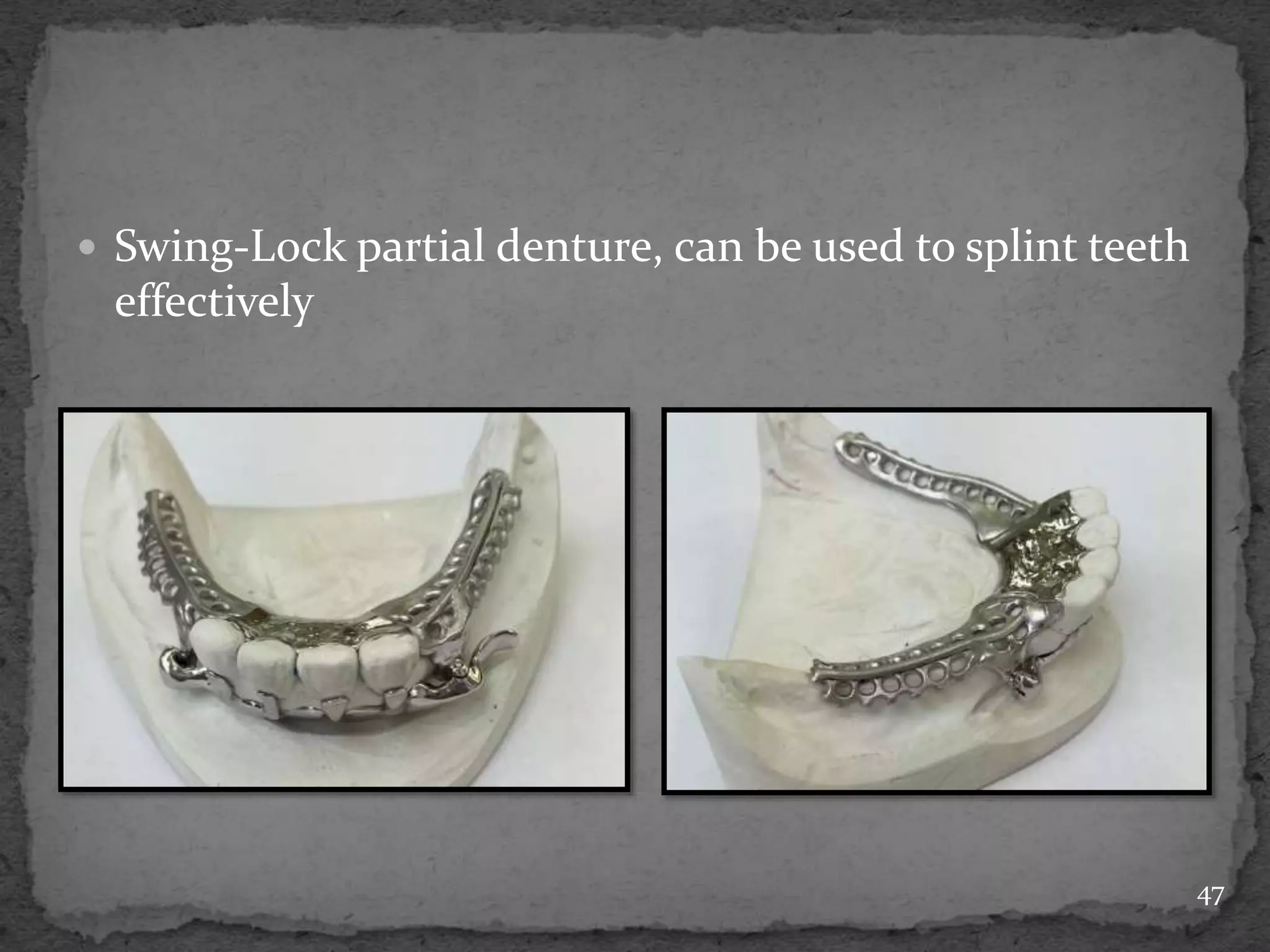 Basic principles of removable partial denture design copy | PPTX