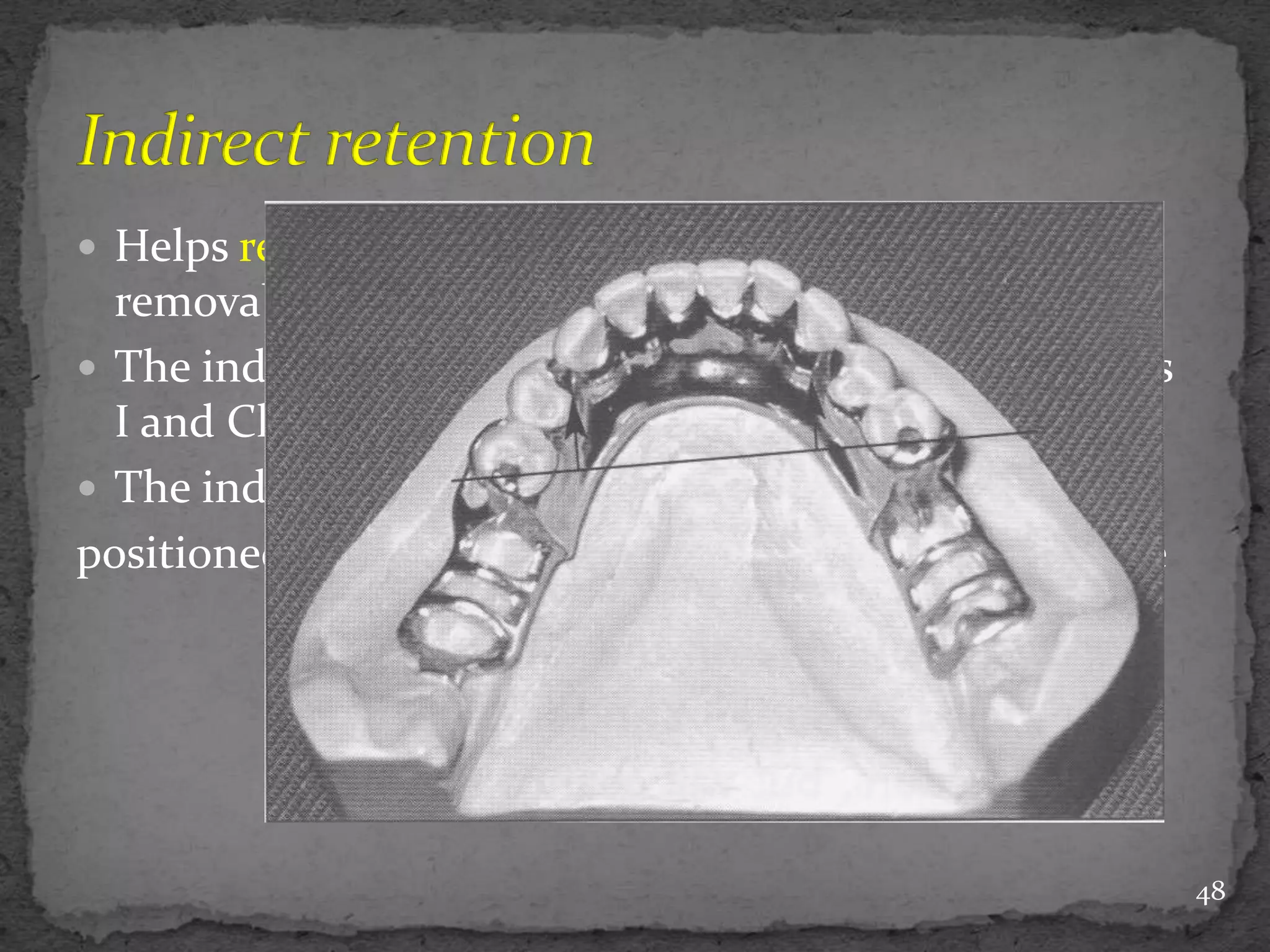 Basic principles of removable partial denture design copy | PPTX