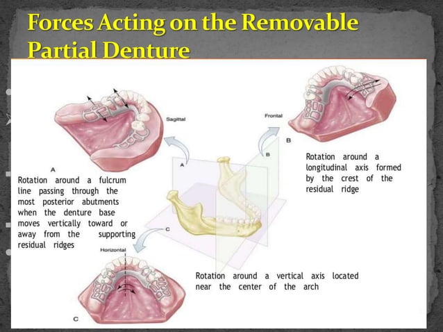 Basic principles of removable partial denture design copy | PPTX ...