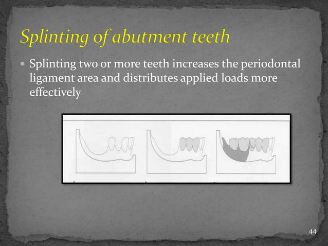 Basic principles of removable partial denture design copy | PPTX ...