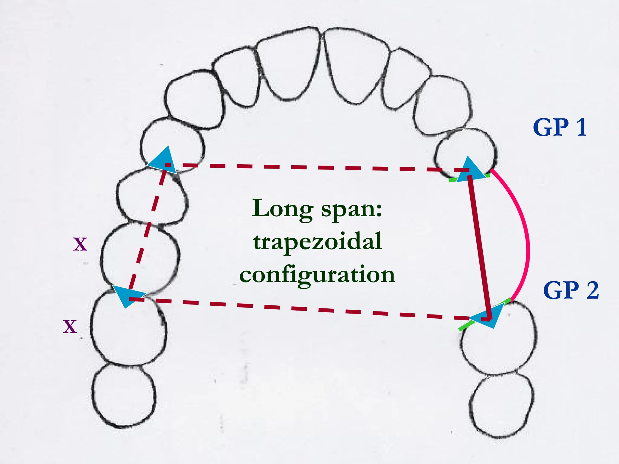 basic_principles_of_removable_partial_denture_design_-_copy.ppt