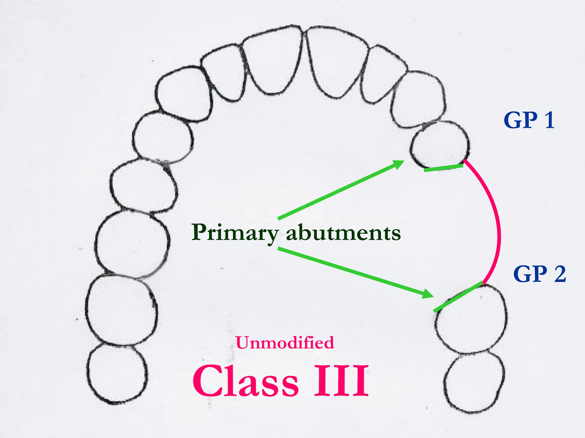 basic_principles_of_removable_partial_denture_design_-_copy.ppt