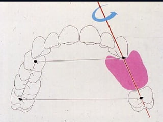 basic_principles_of_removable_partial_denture_design_-_copy.ppt