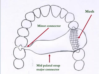 basic_principles_of_removable_partial_denture_design_-_copy.ppt