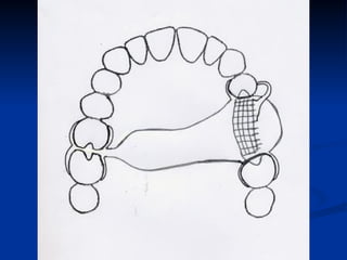 basic_principles_of_removable_partial_denture_design_-_copy.ppt