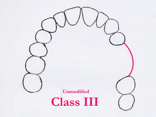 basic_principles_of_removable_partial_denture_design_-_copy.ppt