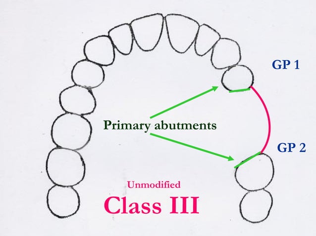 basic_principles_of_removable_partial_denture_design_-_copy.ppt
