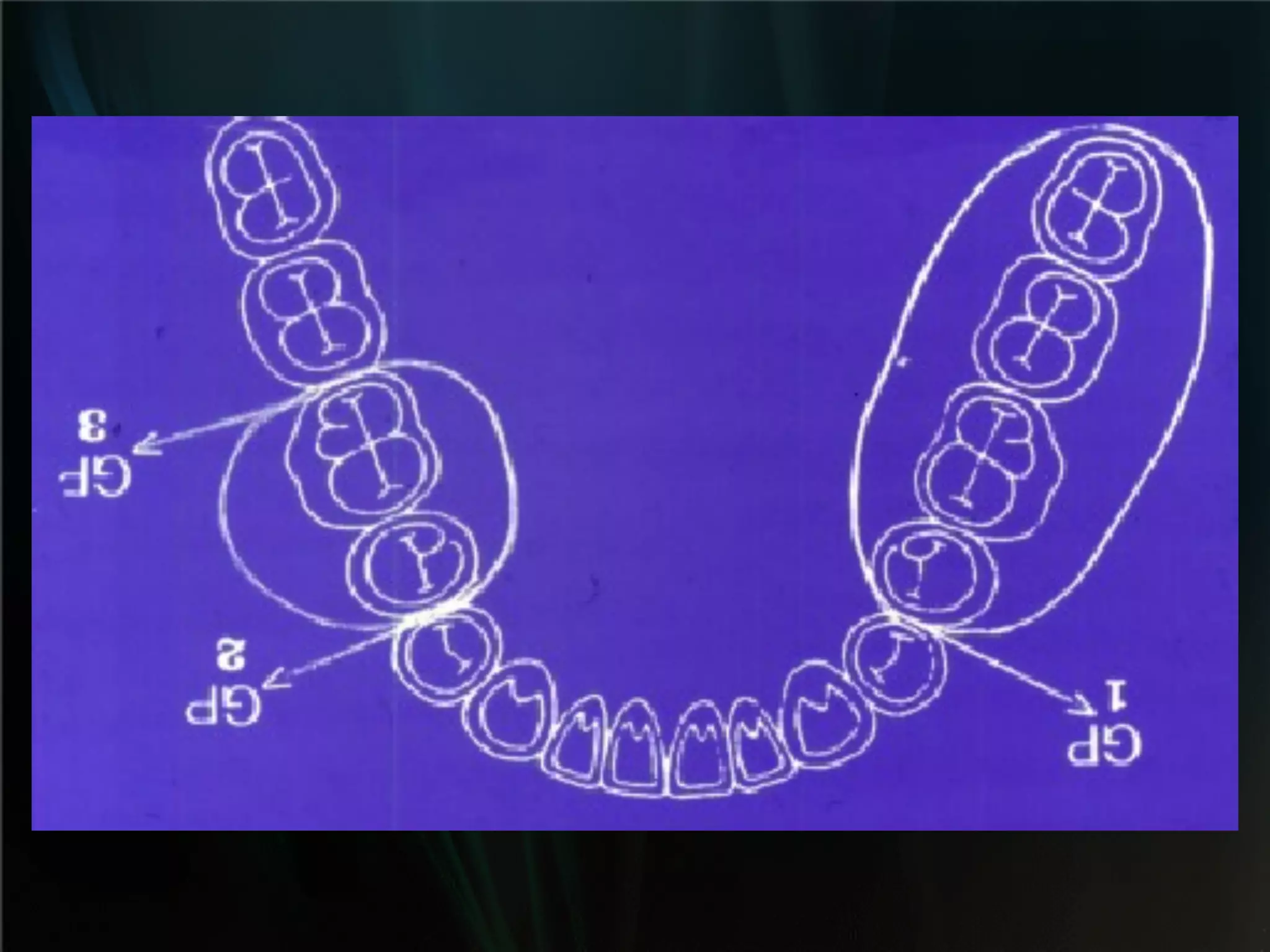 Basic Principles of RPD design I & II.pdf