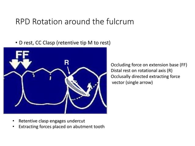 Basic Principles of RPD design I & II.pdf