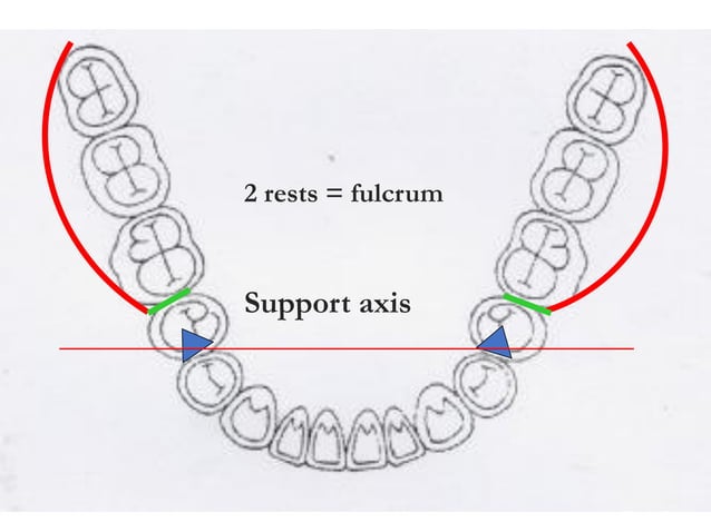 Basic Principles of RPD design I & II.pdf