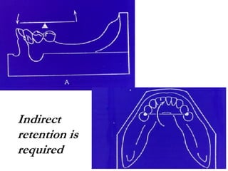 Basic Principles of RPD design I & II.pdf