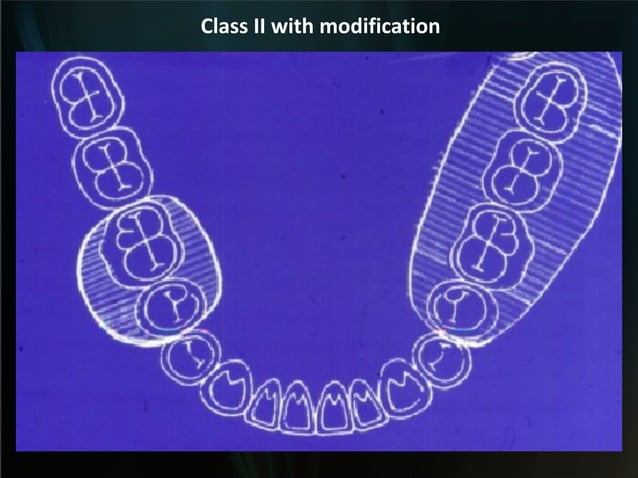 Basic Principles of RPD design I & II.pdf
