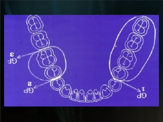 Basic Principles of RPD design I & II.pdf