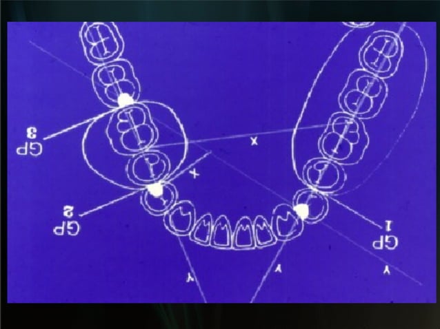 Basic Principles of RPD design I & II.pdf