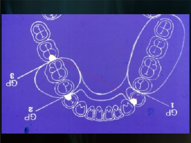Basic Principles of RPD design I & II.pdf
