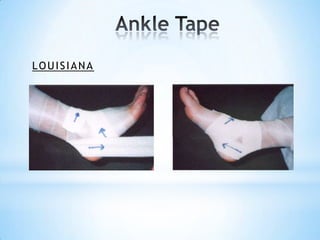 Basic principles of taping techniques - Mr. Marc Lievens | PPTX