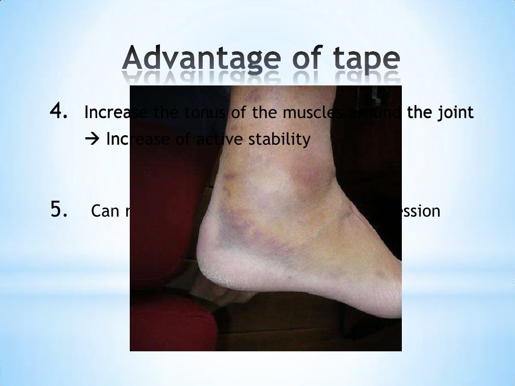 Basic principles of taping techniques - Mr. Marc Lievens