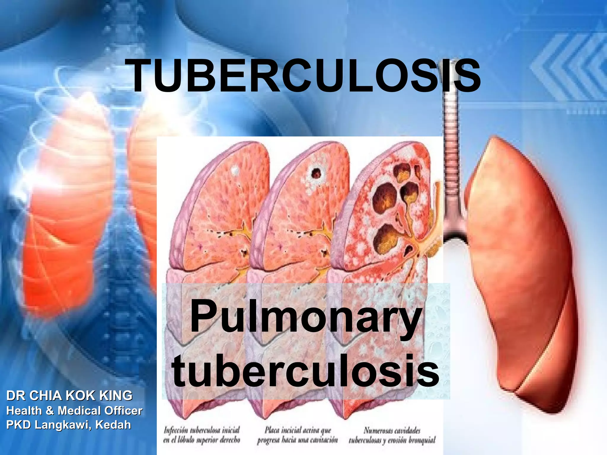 Basic pulmonary tuberculosis intro | PPT